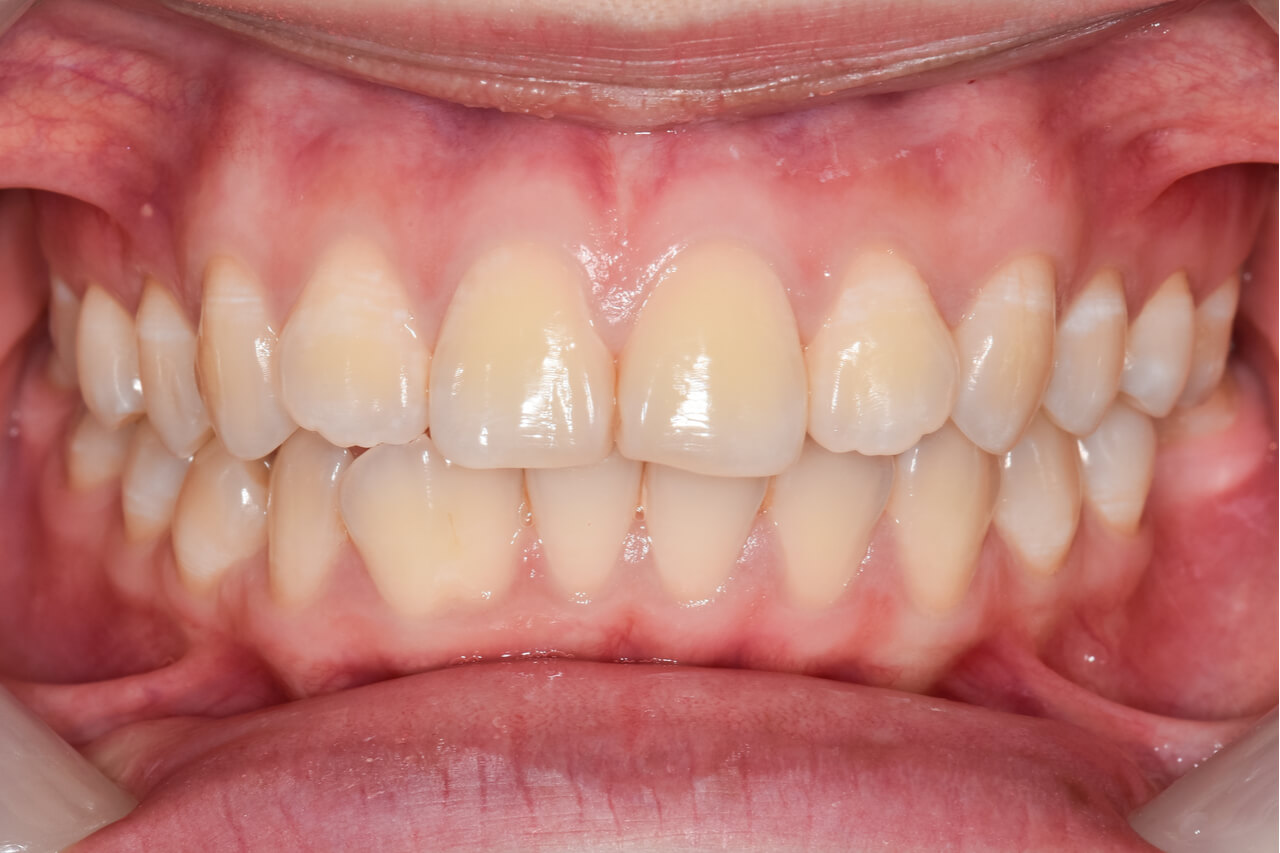 What Are The Symptoms Of Oral Cancer On The Gums 
