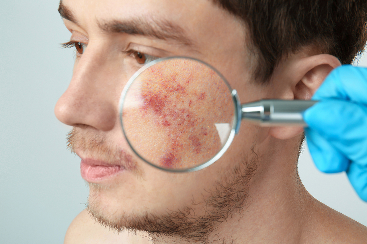 Skin Cancer Surgery On Face Zac s Legacy Foundation Skin Cancer Surgery On Face Zac s Legacy Foundation